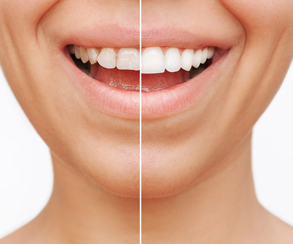 Woman-Smiling-Showing-Smile-Transformed-By-Dental-Crowns-for-mobile.jpg